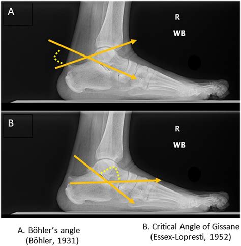The Reliability Of Common Radiographic Measurements Used To Describe