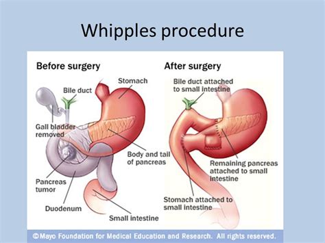 Duodenal Switch Surgery Pancreatic Tissue Histology Diagram Whipple Surgery Whipple Procedure