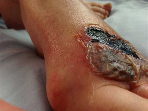 Pyoderma Gangrenosum Dec 3 2012