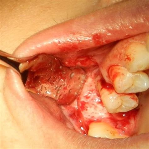 A Traumatic Tooth Extraction By Tooth Separation With Hard And Soft