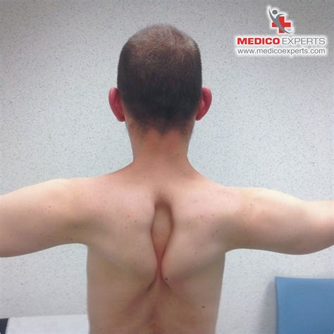 Advanced Limb Girdle Muscular Dystrophy Treatment In India