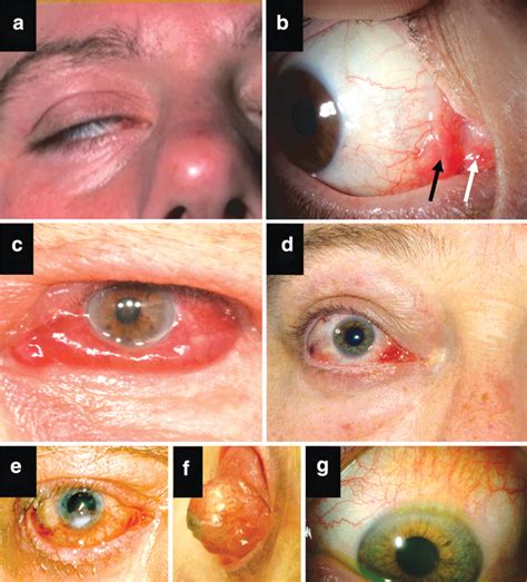 Management Of Thyroid Eye Disease A Consensus Statement By The