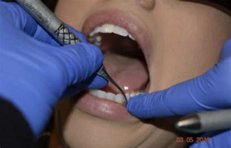 Lecture 4 Advanced Instruments For Perio Therapy Flashcards Quizlet