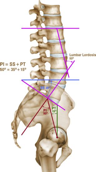 Spinopelvic Parameters Lumbar Lordosis Pelvic Incidence Pelvic Tilt