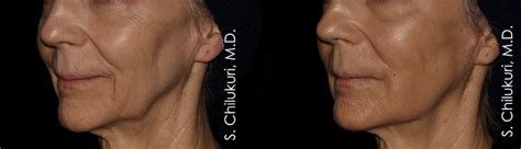 Kybella Archives Refresh Dermatology