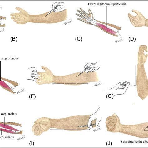 Injection Technique For The Finger And Wrist Flexors A Flexor Download Scientific Diagram