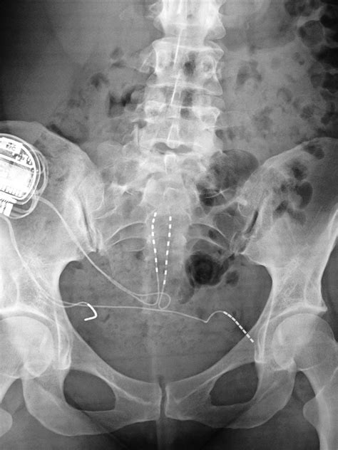 Combined Site Specific Sacral Neuromodulation And Pudendal Nerve