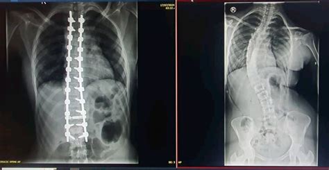 Correction Of Long Thoracic Curve With Shoulder Pelvic Imbalance And Rib Hump In Adult
