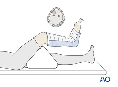 Nonoperative Treatment Splinting For Isolated Fibular Fracture