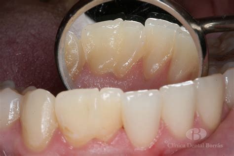 Geminación Dental Clínica Dental Borrás