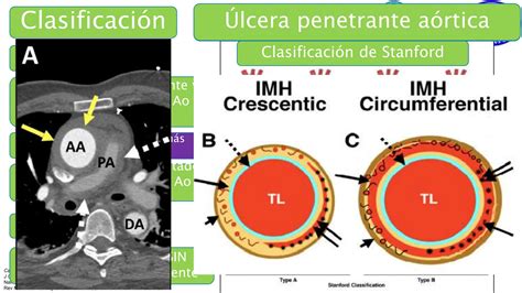 Aneurisma Aórtico Torácico Y Síndromes Aórticos Agudos Corregido 1pptx