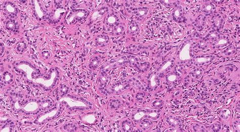 Bile Duct Histology Bile Duct Adenoma Basicmedical Key