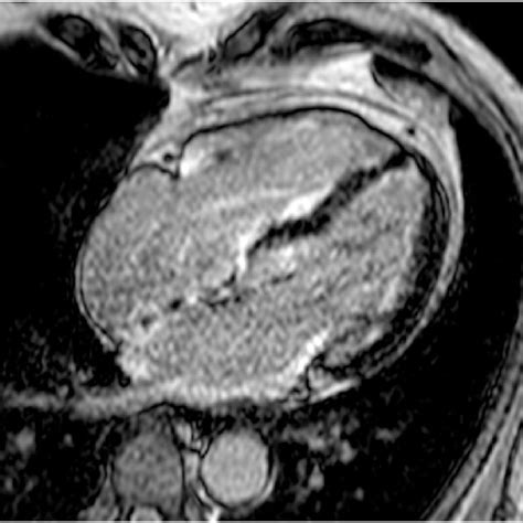 inversion recovery sequence to evaluate lge 4 chamber view the image