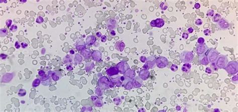 ¿qué Es La Trombocitosis Esencial Homo Medicus
