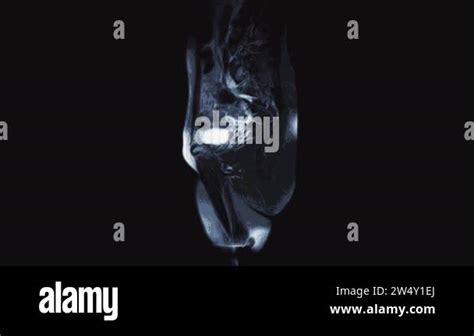 Voluminous Color Mri Of The Female Pelvic Organs Abdominal Cavity Gastrointestinal Tract And