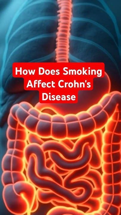 What Happens When You Quit Smoking Crohns Disease