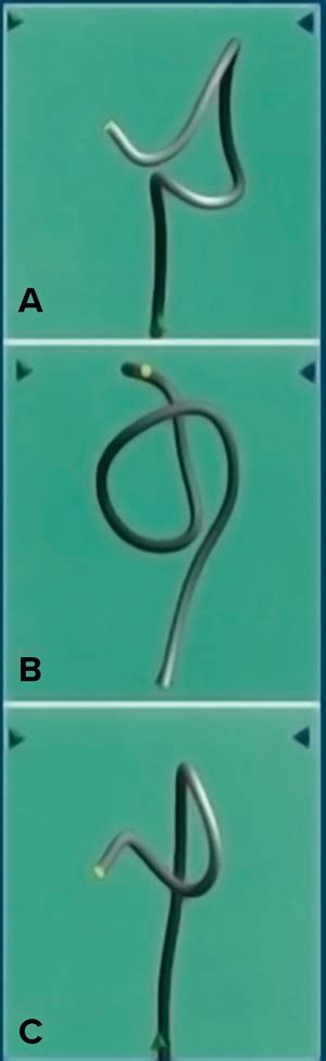 Splenic Injury In Colonoscopy