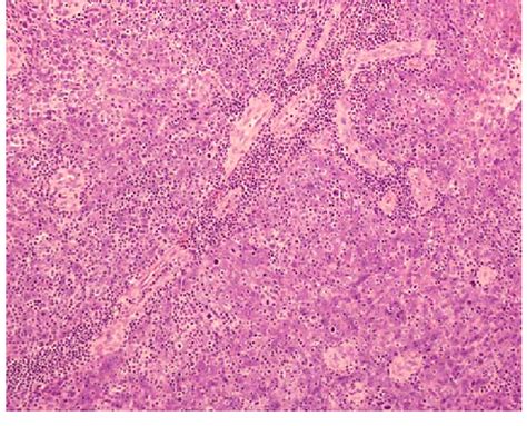 Sheets Of Epithelial Cells Show A Syncytial Architecture With