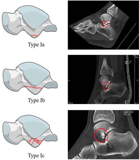 New Classification Based On Ct And Its Value Evaluation For Fractures Of The Lateral Process Of