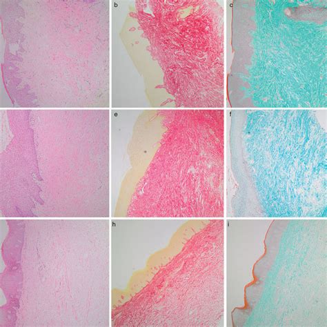 Case 2 Hyperplastic Lesion At Sites 9 And 10 Following Soft Tissue