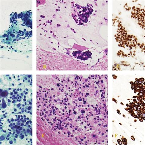 A Round Hypoechoic Well Defined Lymph Node With A 7 Mm Short Axis