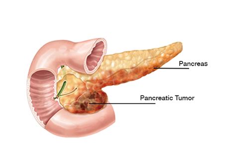 Endoscopic Pancreatic Necrosectomy In Gachibowli