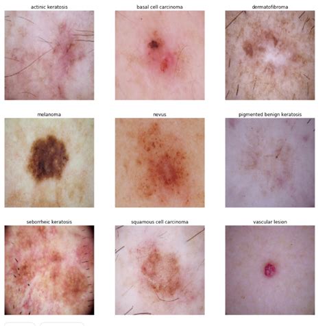 GitHub Pradeeproy Melanoma Detection