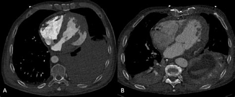 A Computed Tomography Ct Showing The Pseudoaneurysm After Left