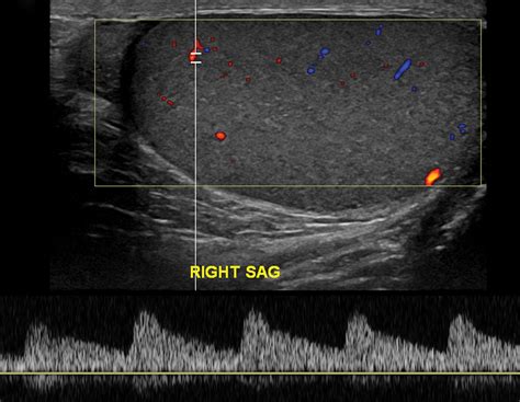 Imaging Of Traumatic Injuries To The Scrotum And Penis Ajr