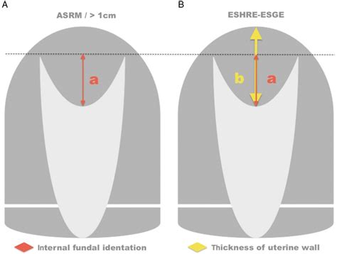 Diagnosis Of Rs A American Society Of Reproductive Medicine Asrm