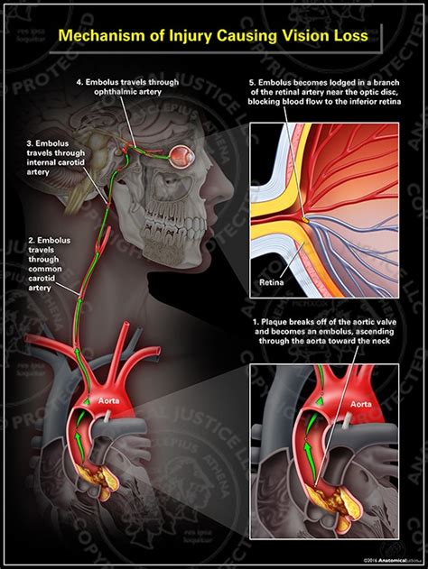 Embolism In Retinal Artery Causing Vision Loss