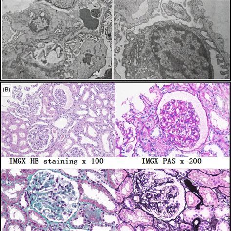 Renal Pathological Examination Results Of Case Iv‐1 Mild Proliferation Download Scientific