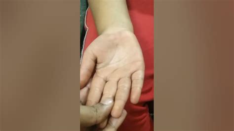 Phalen Test Median Nerve Compression Youtube