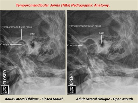 Temporomandibular Joint Tmj Xray Positioning Wpyo