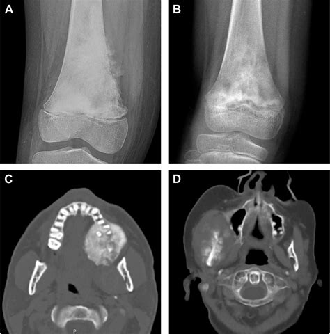 Osteosarcoma Surgical Pathology Clinics
