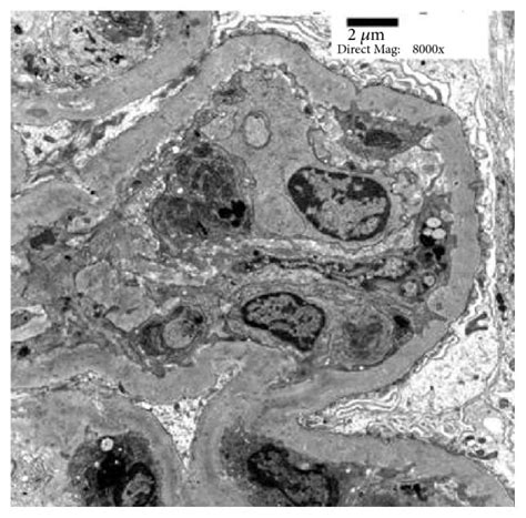 Poststreptococcal Glomerulonephritis Psgn At Magda Salas Blog