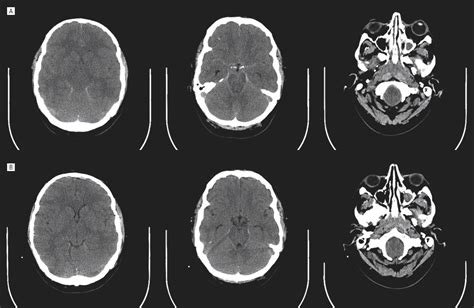 Ct Scan Meningitis At Andrew Webber Blog