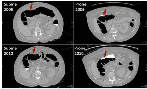 Ct Colonography Algorithm Helps Radiologists Recognize Polyps
