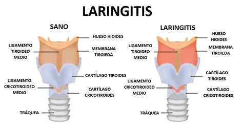 Laringitis Contagiosa Cómo Se Transmite Síntomas Tratamiento Y Consejos Doctor Online