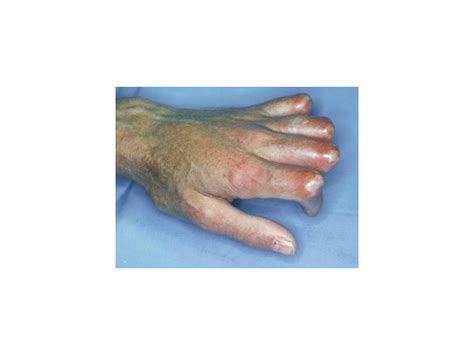 Nesps The Dorsal Bipedicle Flap For Proximal Interphalangeal