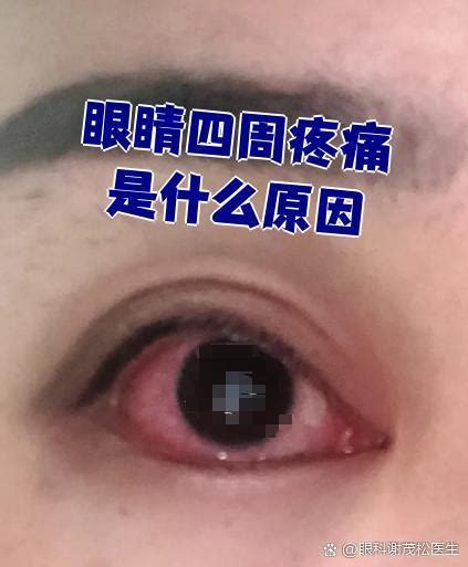 眼睛四周疼痛是什么原因