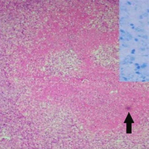 Caseation Necrosis Bordered By Epithelioid Cells And A Few Giant Cells