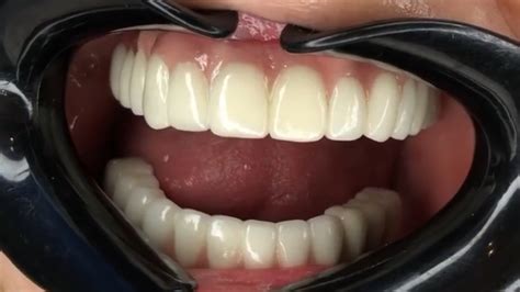 فیلم قبل و بعد از ایمپلنت فک بالا و پایین نماشا