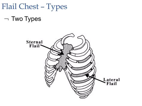 Flail Chest Pptx