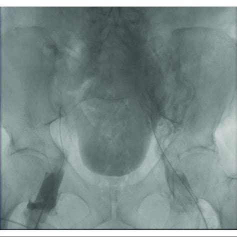 Venogram Of Bilateral Femoral And Iliac Veins On Admission Download