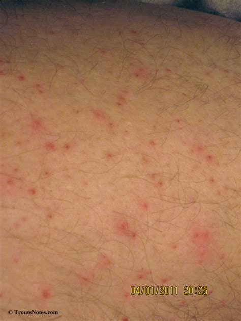 Ehrlichia Rashimg5333 Trouts Notes