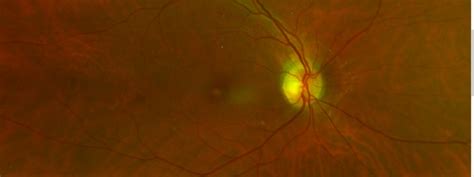 Adult Onset Foveomacular Vitelliform Dystrophya Teaching Case Report