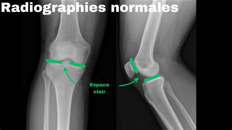 Diagnostic Arthrose Du Genou Pr Etienne Cavaignac