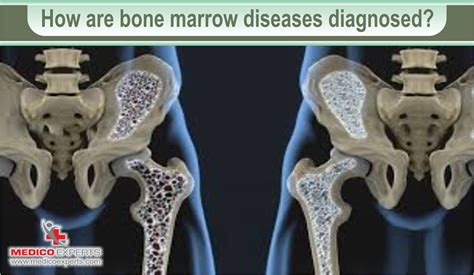 Your Ultimate Guide To Bone Marrow Diseases And Recovery