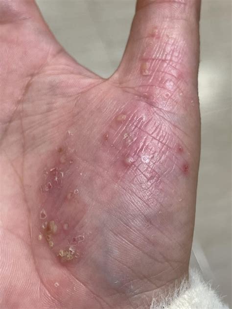Palmoplantar Pustular Psoriasis Or Dyshidrotic Eczema R Psoriasis